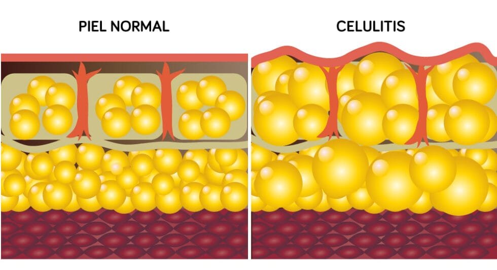 Celulitis edematosa, qué es, síntomas, causas y tratamiento