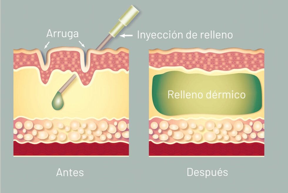 Surcos nasogenianos que son y como tratarlos